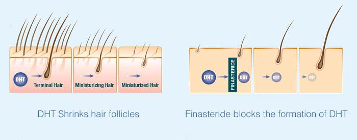 ANTI DHT Hair Loss Treatment Malaysia [How To Combat DHT] - Toppik Malaysia